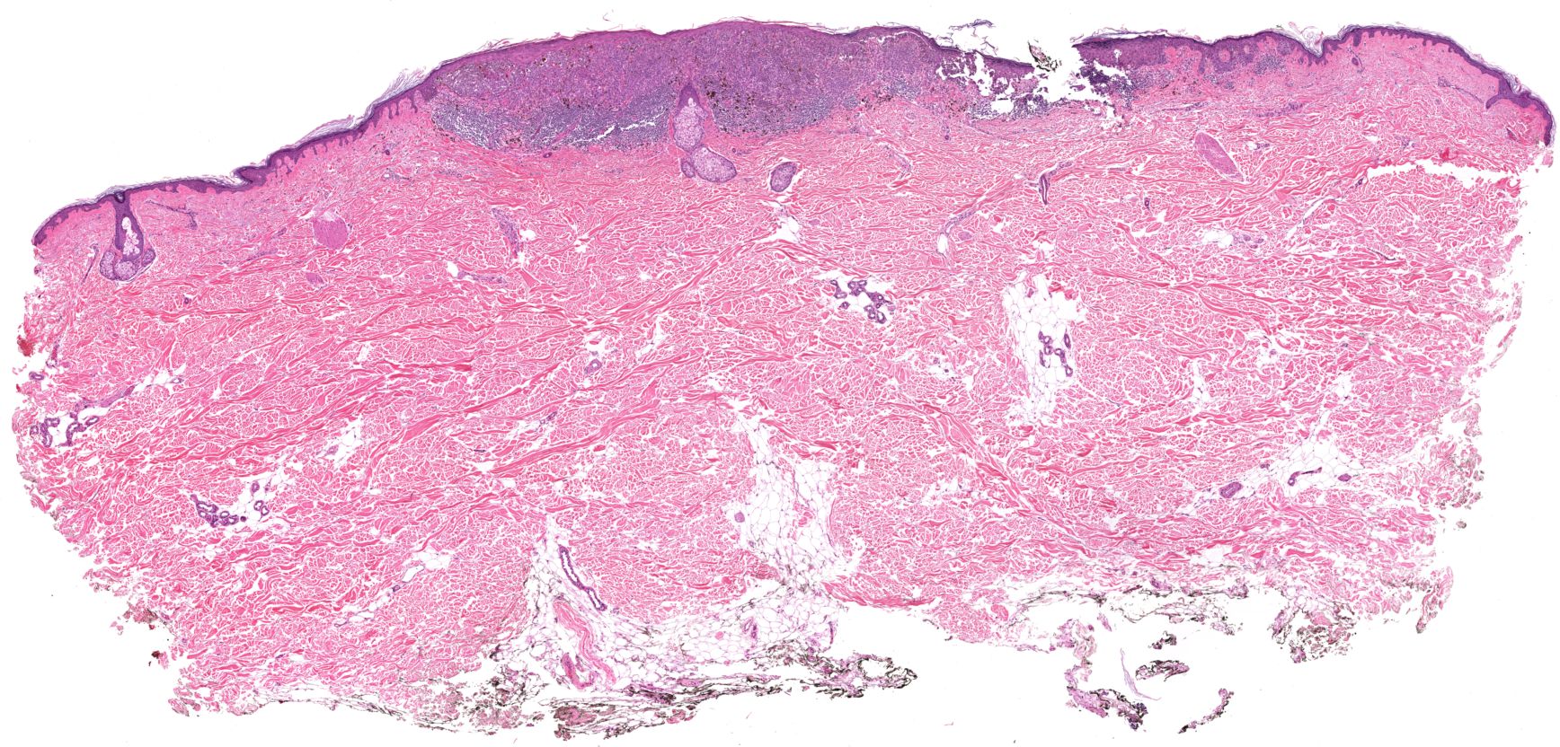 Histopath - Dermatologists Sans Borders